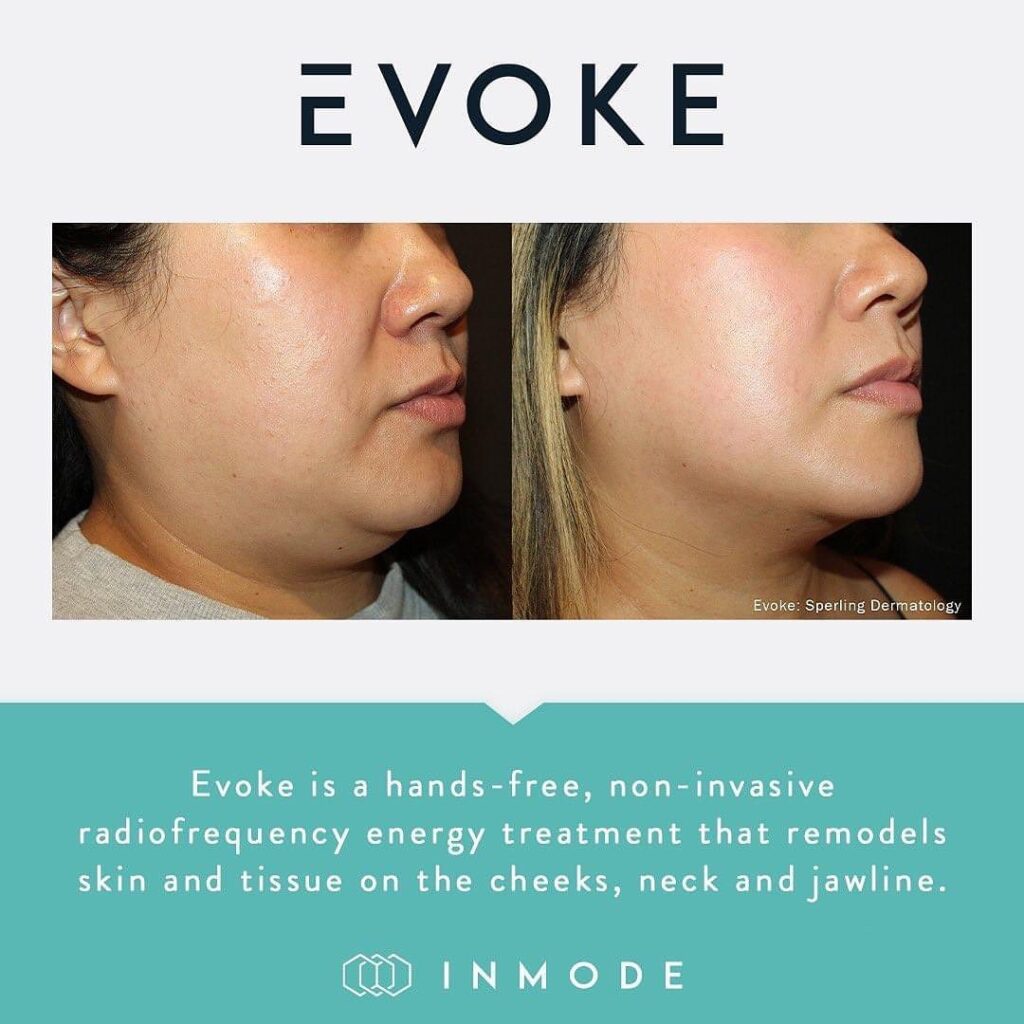 Sculpt and Define: How Evoke by InMode Transforms Your Facial Contours ...