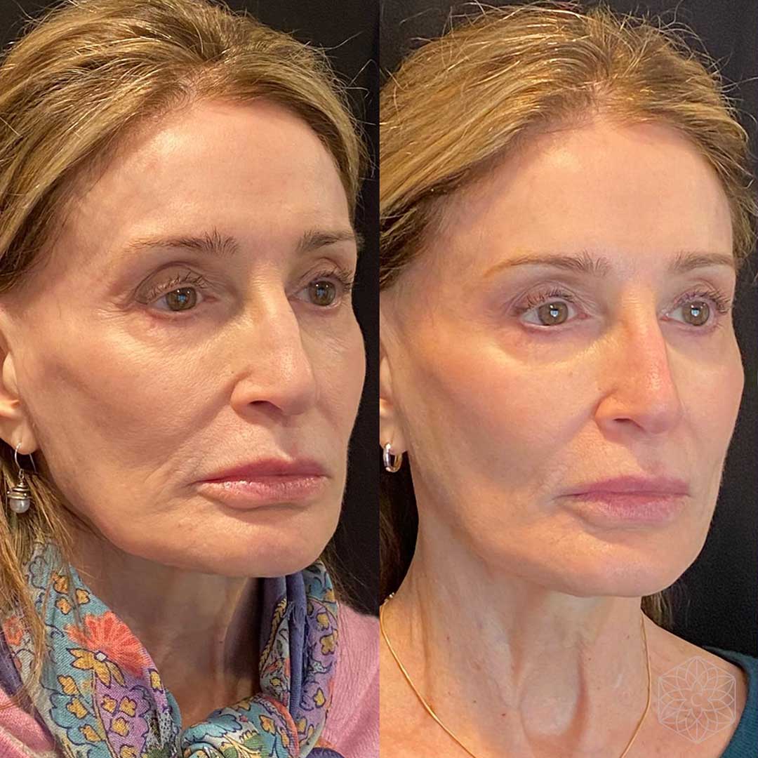 What is a Liquid Facelift? - Health Horizons USA