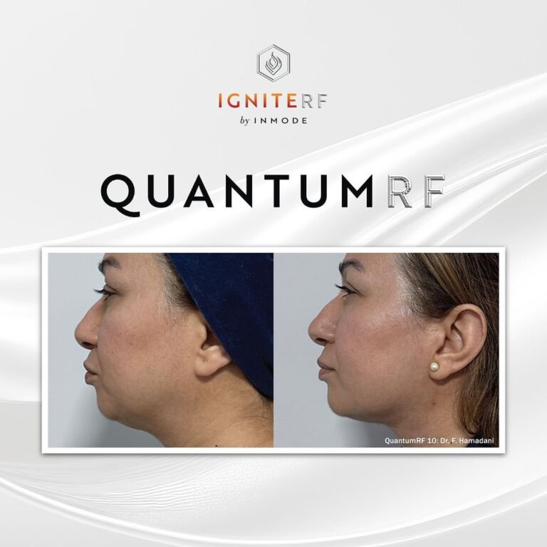 Introducing Quantum RF by InMode at Health Horizons - Health Horizons USA